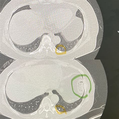폐 Ct 사진좀 봐주실수 있을까요 비교 사진 올렸습니다 ㅣ 궁금할 땐 아하