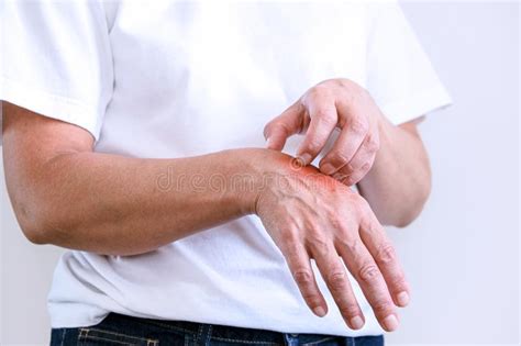 Mujer Que Rasguña Un Picor Piel Sensible S ntomas De La Alergia