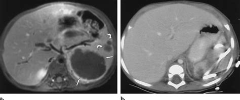 Splenic Abscesses In A 3 Year Old Female Patient A Axial T1 Weighted