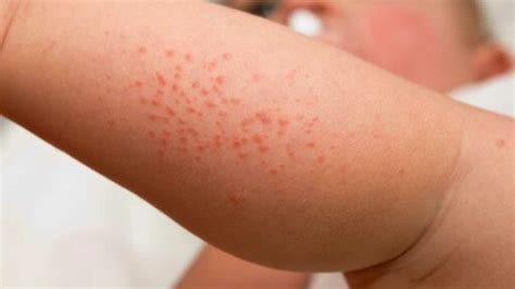 What Does Scleroderma Rash Look Like Torrinomedica