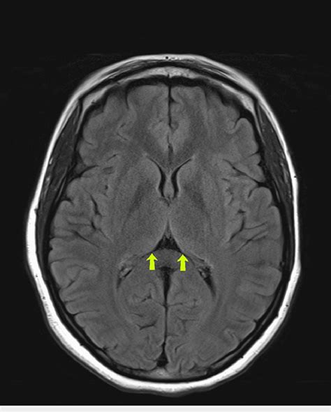 Magnetic Resonance Imaging Mri Brain With And Without Contrast