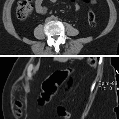Ct Images Demonstrating Recurrent Subxiphoid And Midline Hernias Download Scientific Diagram