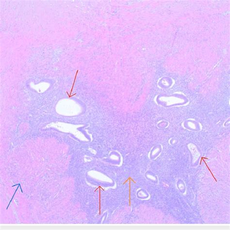 Red Arrows Show Endometrial Tissue With A Glandular Structure Embedded