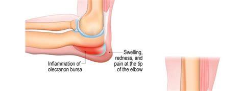 What Is Elbow Bursitis Orthopaedics Toronto OrthoTO