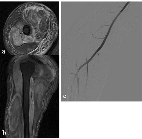 Pectineus Muscle Hematoma At Ellie Ridley Blog