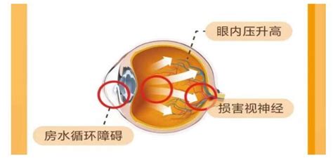 爱尔眼科护理科普：节假日不担心，青光眼患者术后应该怎样吃中华网