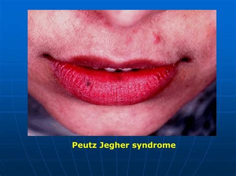 Ppt Comprehensive Guide To Mouth And Salivary Gland Diseases Powerpoint