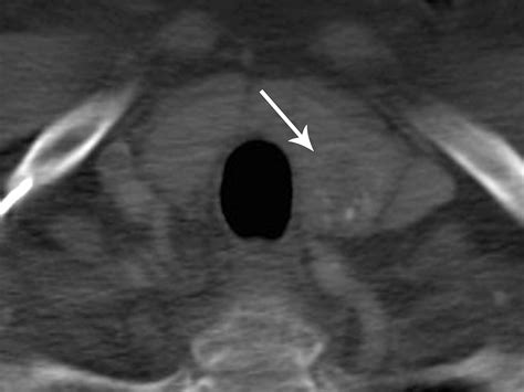 Significance Of Incidental Thyroid Lesions Detected On Ct Correlation