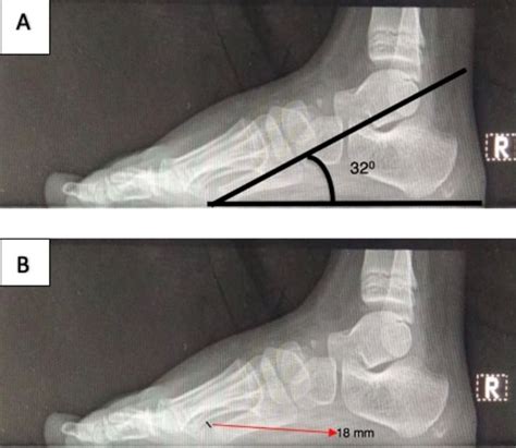 Rare Condition Of Congenital Intermetatarsal Coalition With Deformity