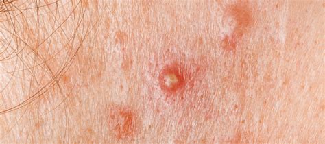 Nodular Back Acne