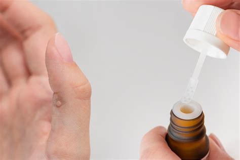 Premium Photo Cure For Warts Bottle With Medicine For The Treatment