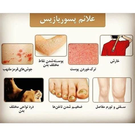 ️ پسوریازیس چیست، چه علائمی دارد و چگونه درمان می شود؟ پسوریازیس یا