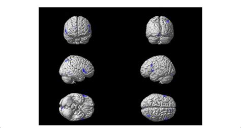 Olume Reduced Gray Matter In Diierent Brain Regions In Mdd Patients And