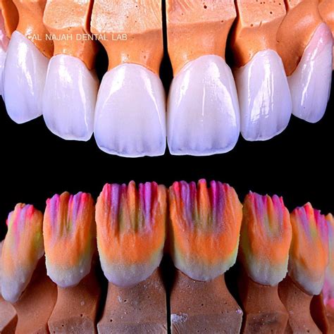 Zircon Crowns And Bridge Layered With Bl4 Shade Lens Of A Young