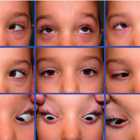 A Axial Orbital Ct At The Level Of The Trochlearsuperior Oblique