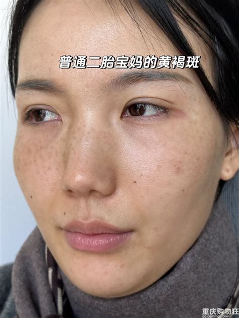 黄褐斑雀斑晒斑等混合斑占了我8年青春纯分享贴 变美有招 重庆购物狂