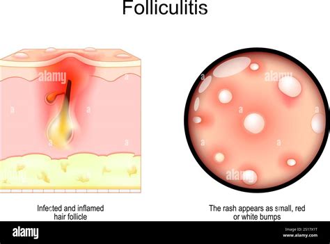 Infected Hair Follicle