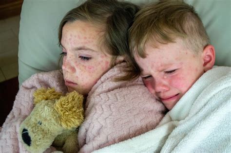 Vacunación natural enfermedad contagiosa niño enfermo con varicela