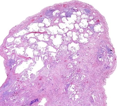 Path Restrictive Lung Diseases Pics Flashcards Quizlet