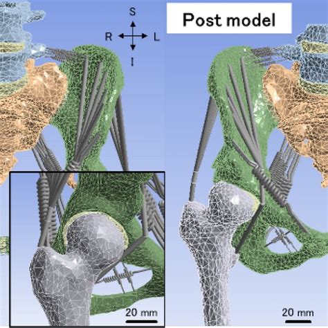Finite Element Models Of The Preoperative Left And Postoperative Download Scientific Diagram