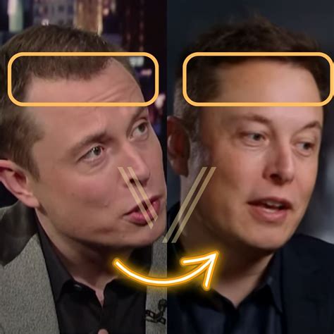 Elon Musk Hair Transplant Before And After Transformation
