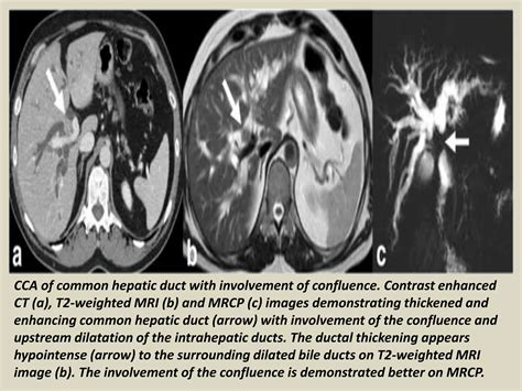 Presentation1 Pptx Radiological Imaging Of Cholangiocarcinoma Pptx