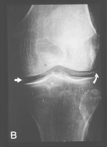 Osteoarthritis And Cppd Flashcards Quizlet