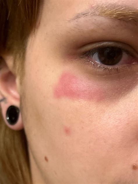 Itchy Rash On Face Rdermatologyquestions