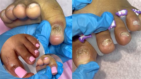 Brittle Toe Nail Repair At Marion Rosenthal Blog