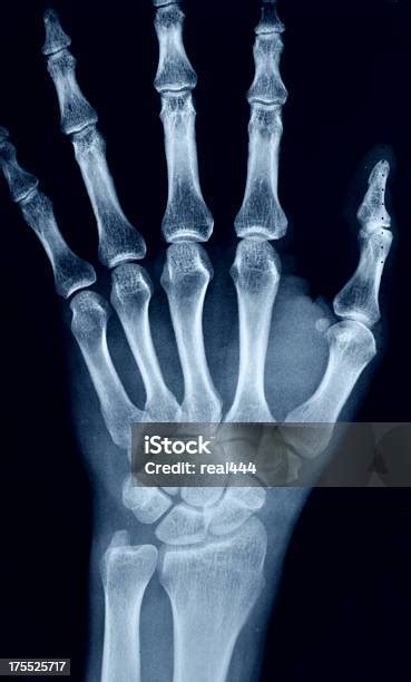 Tangan Gambar Sinarx Foto Stok Unduh Gambar Sekarang Anatomi