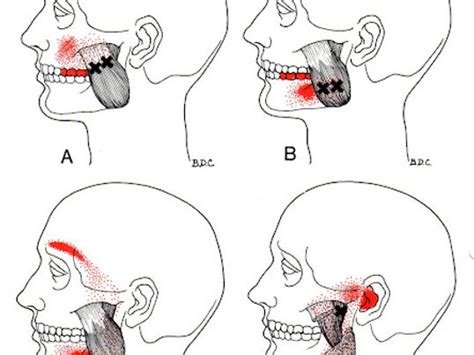 Unlock Relief From Tmj Pain The Power Of Massaging Your Masseter And