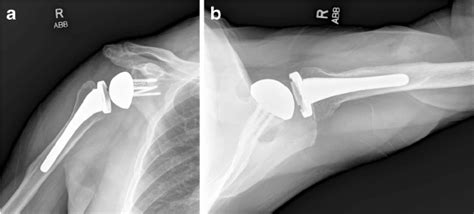 Grashey And Axillary Lateral Images Radiography Ortho Shoulder