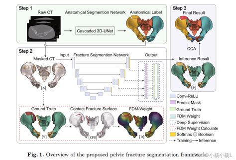 基于多尺度距离加权神经网络的骨盆骨折分割pelvic Fracture Segmentation Using A Multi Scale D