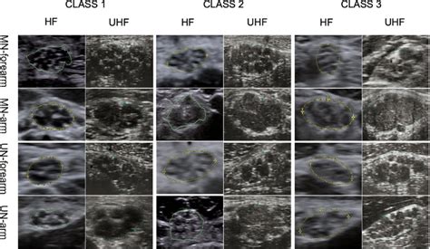Patterns Of Nerve Echogenicity Hf High Frequency Probe Uhf