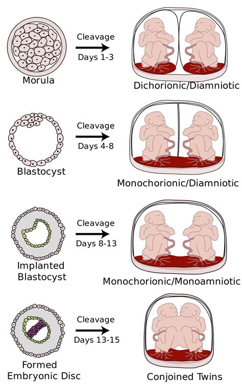 Monoamniotic Twins Wikipedia