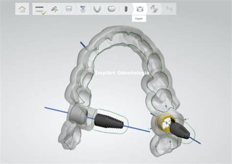 Cirurgia De Implantes Dentários Guiada Por Computador Guia Cirúrgico