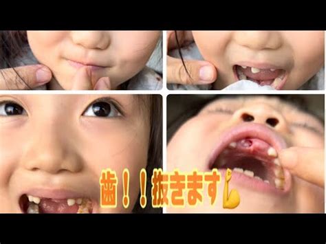 抜歯セルフずっとぐらぐらしてた歯を抜くよ YouTube