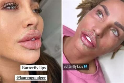 Expert Warns Against Butterfly Lips Filler Trend That Uses Tape To Give Definition Ok Magazine