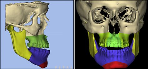 Figure 4 From Anterior Open Bite Correction With 2‐jaw Orthognathic