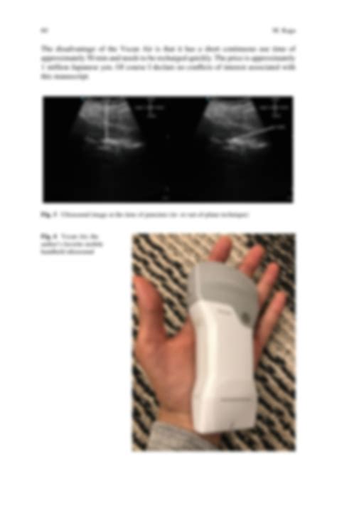 Solution Hydrodissection Of Piriformis Syndrome Studypool