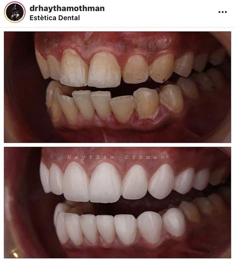 Before And After Photo Of Procelain Veneers By Drhaythamothman The Top