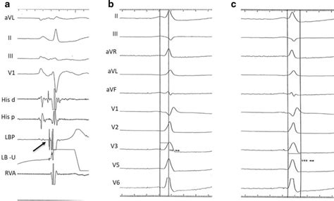 A Intracardiac Electrogram Showing His Bundle Potential On His Distal