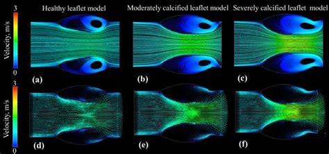 Velocity Streamline Contour And Velocity Vector Plots For Healthy