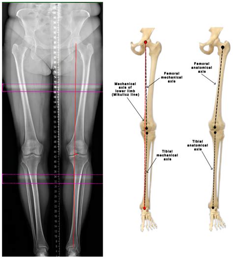 Radiological Approach To Assessment Of Lower Limb Alignment—coronal And