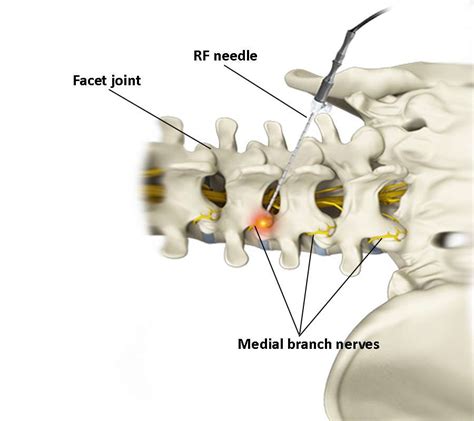 Medial Branch Nerve RF Ablation Solving Back And Neck Pain