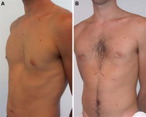 Pectus Excavatum Surgery