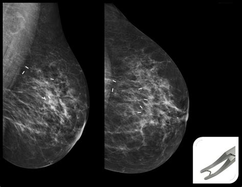 Surgical Clips Mammogram Shows Linear Radiopaque Clips Placed During Download Scientific