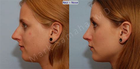 Rhinoplastie Rhinoplasty Avant Après Photos Before and After