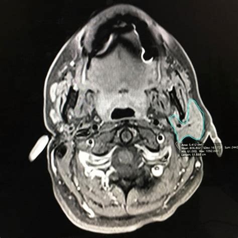 Parotid Gland Border With Osirix® Program For Volume Measurement