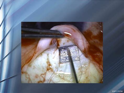 Ppt Ex Press® Device In Clinical Practice New York September 2011 Powerpoint Presentation